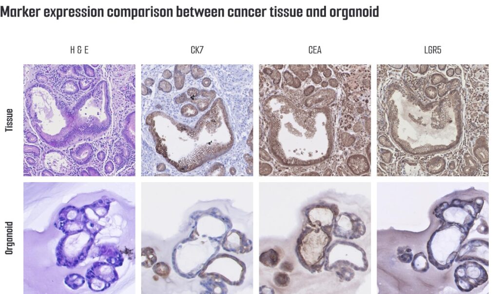 Gastric Cancer Organoid - Lambda Biologics