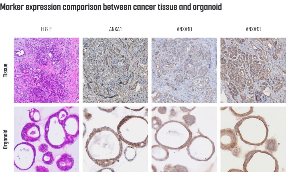 Pancreatic Cancer Organoid - Lambda Biologics